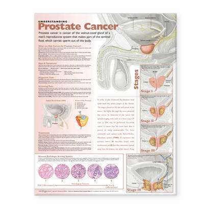 Understanding Prostate Cancer Anatomical Chart | Buy Now | at Mighty Ape NZ